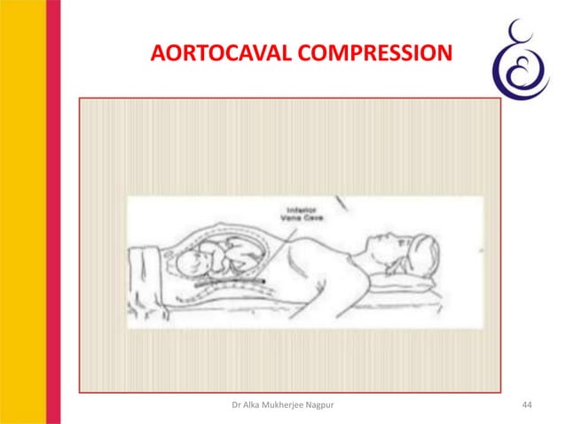 Maternal collapse by dr alka mukherjee & dr apurva mukherjee | PPTX ...