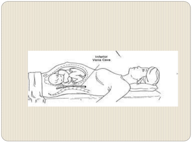 Maternal collapse during pregnancy and puerperium | PPTX