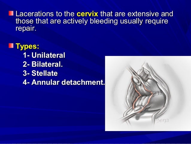 Maternal obstetric injuries for undergraduate