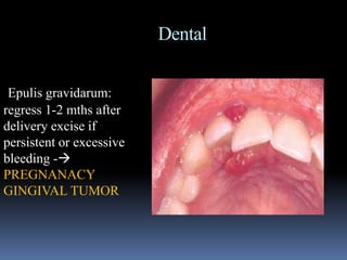 Epulis Gravidarum