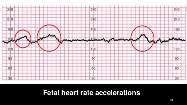 Fetal Assessment During Labor