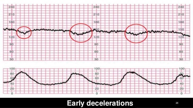 Fetal Assessment During Labor
