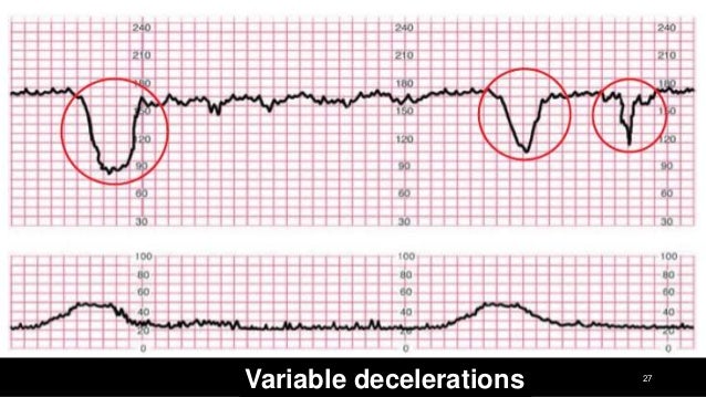 Fetal Assessment During Labor