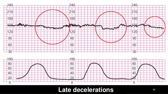 Fetal Assessment During Labor