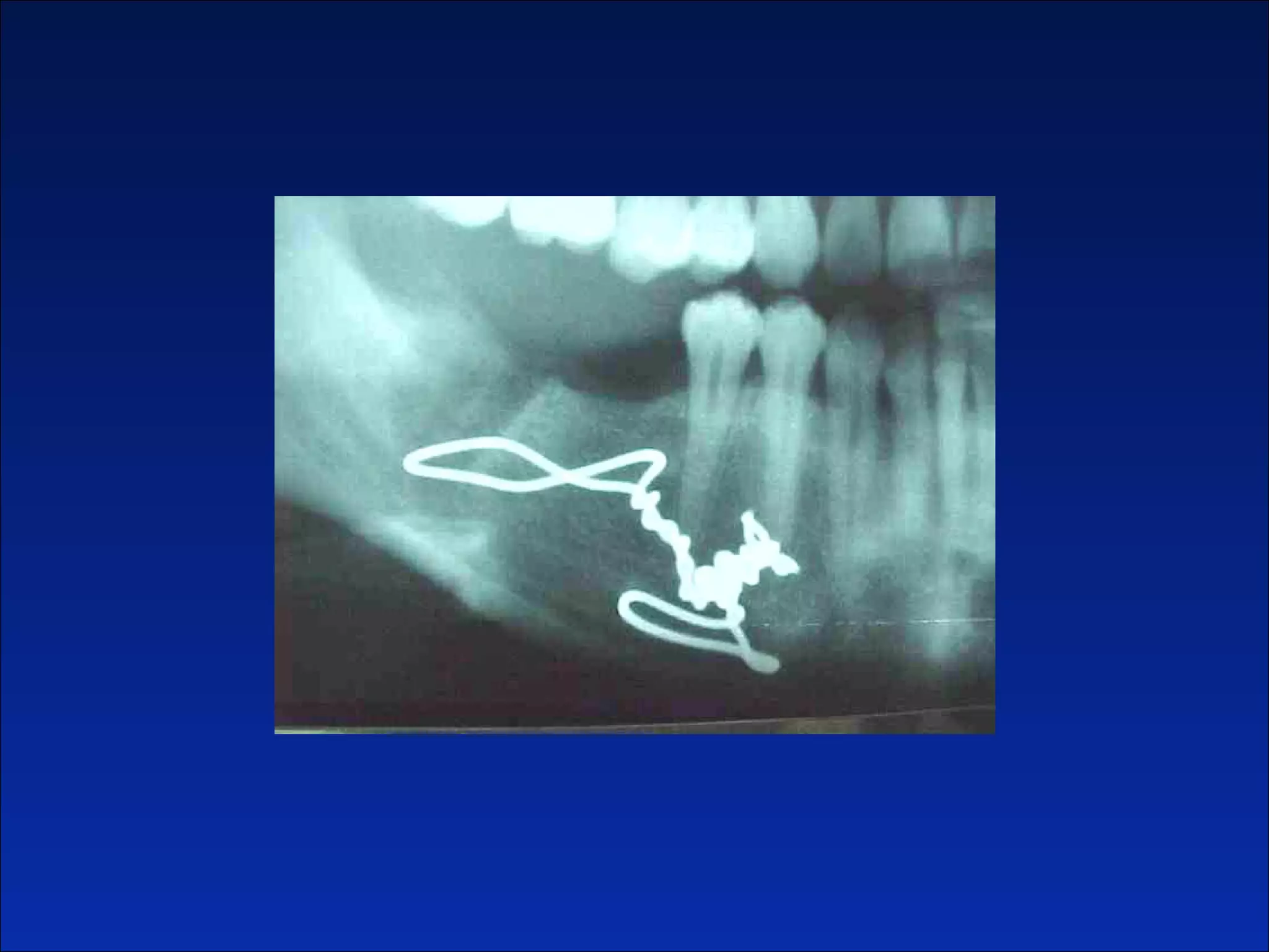Material Osteosintisis Sintomatico | PPT