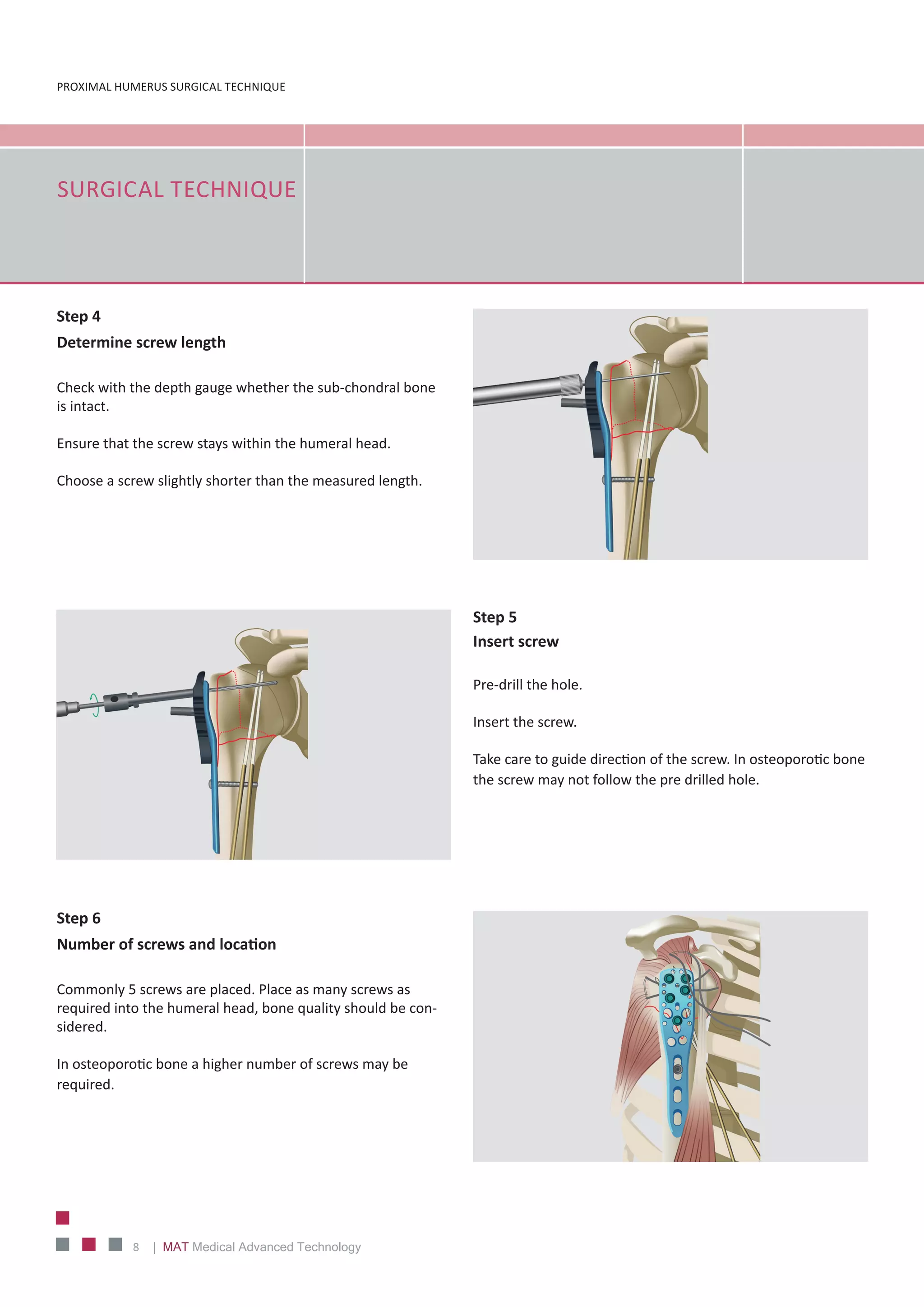 MAT - Proximal Humerus Plate | PDF