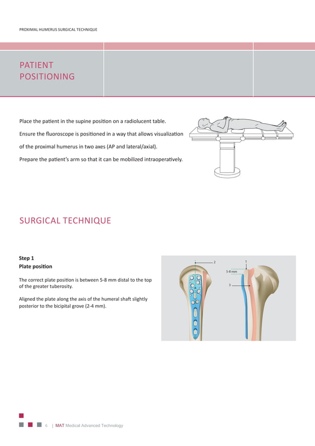MAT - Proximal Humerus Plate | PDF