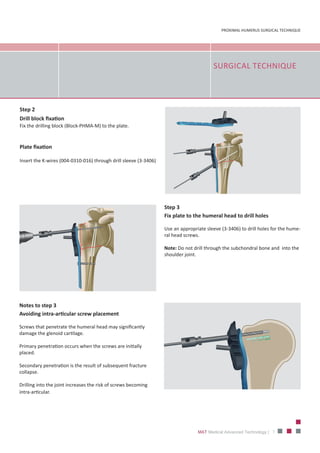 MAT - Proximal Humerus Plate | PDF