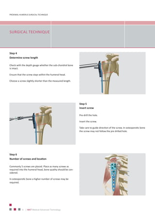 MAT - Proximal Humerus Plate | PDF