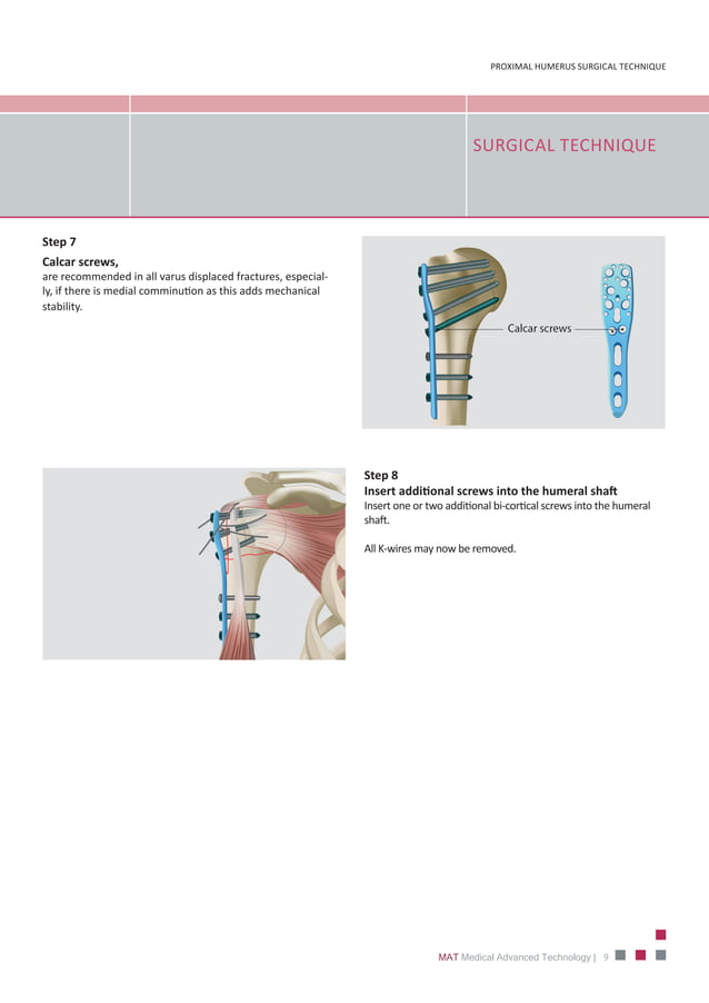 MAT - Proximal Humerus Plate | PDF
