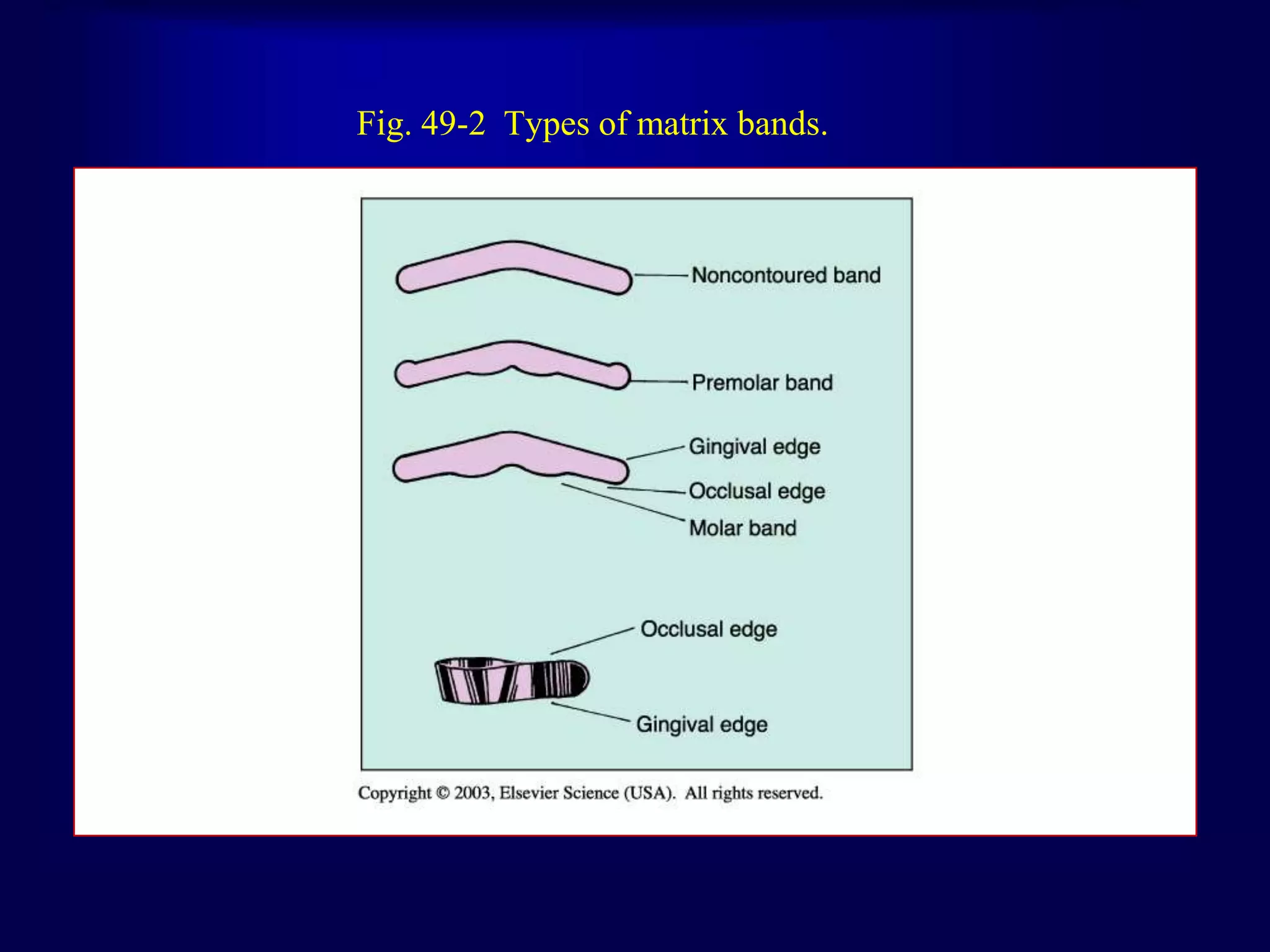 Matrices in-pediatric-restorative-dentistry | PPTX