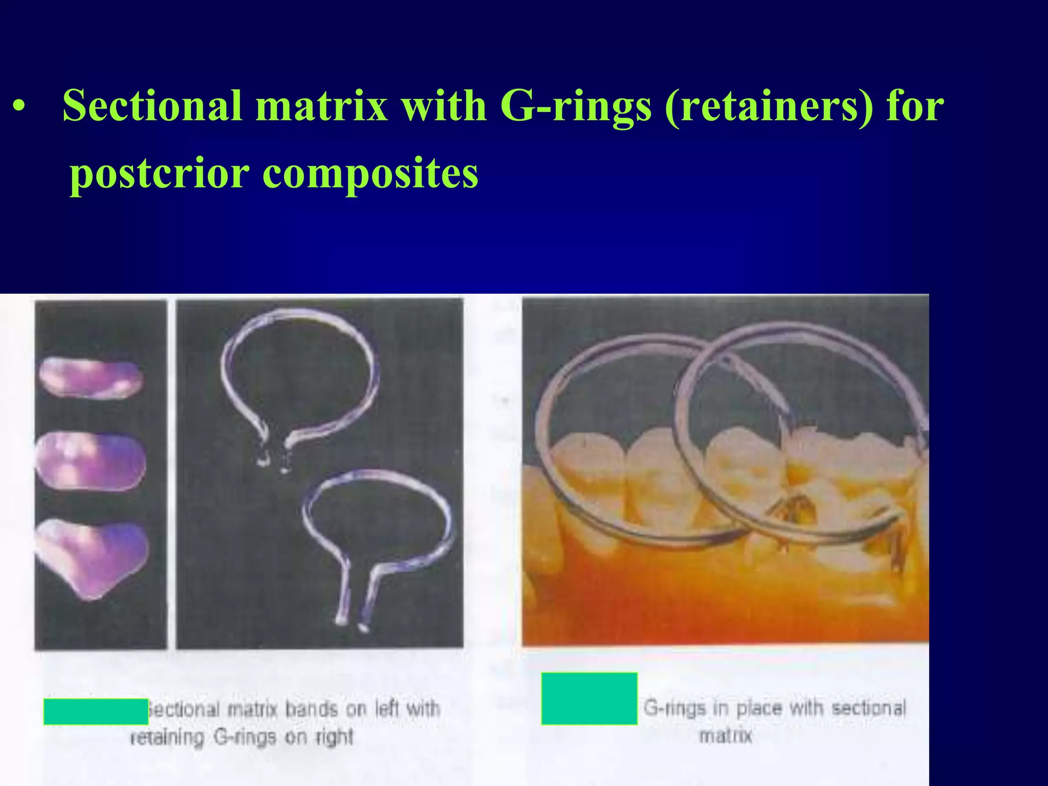 Matrices in-pediatric-restorative-dentistry | PPTX