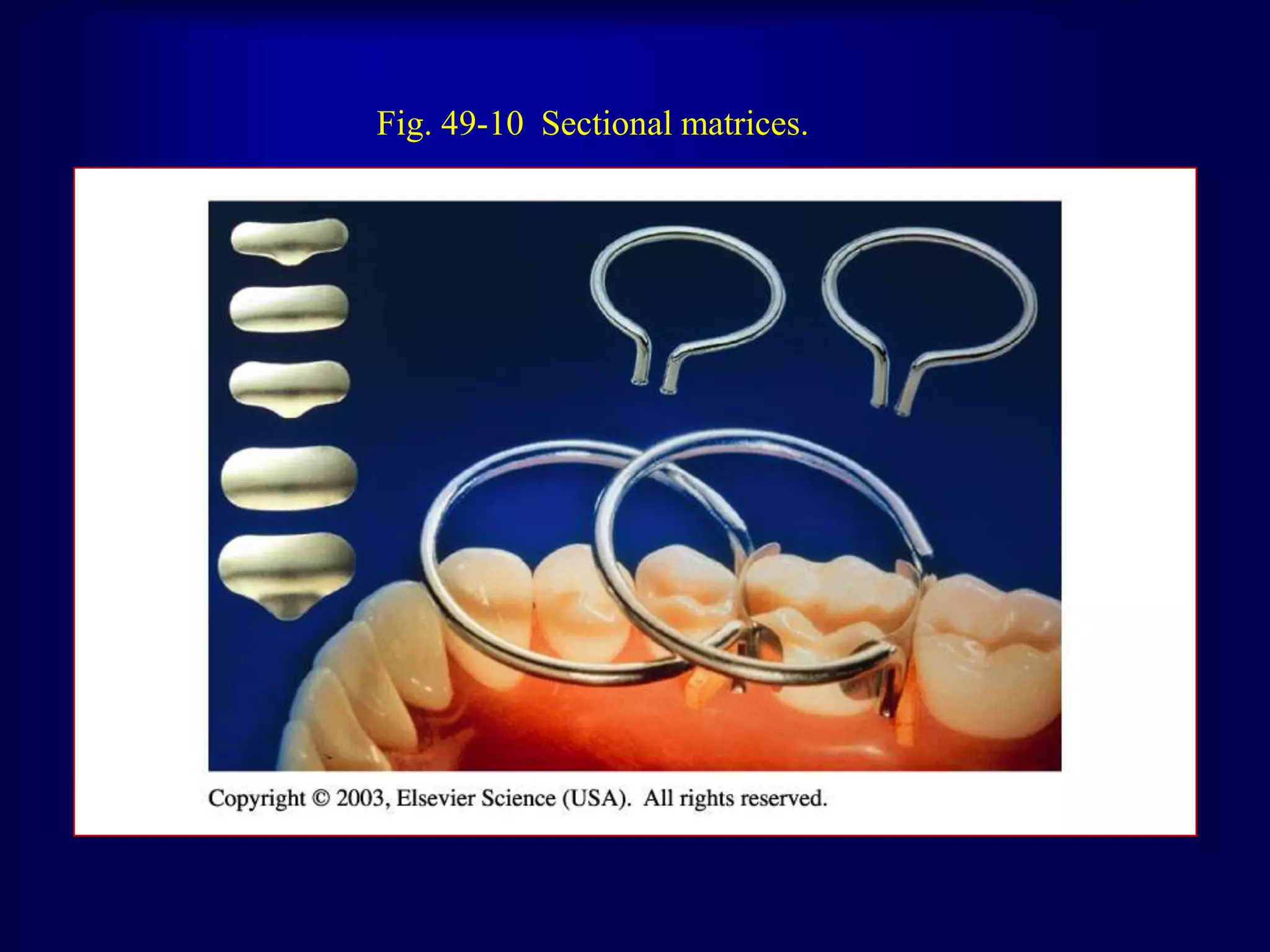 Matrices in-pediatric-restorative-dentistry | PPTX