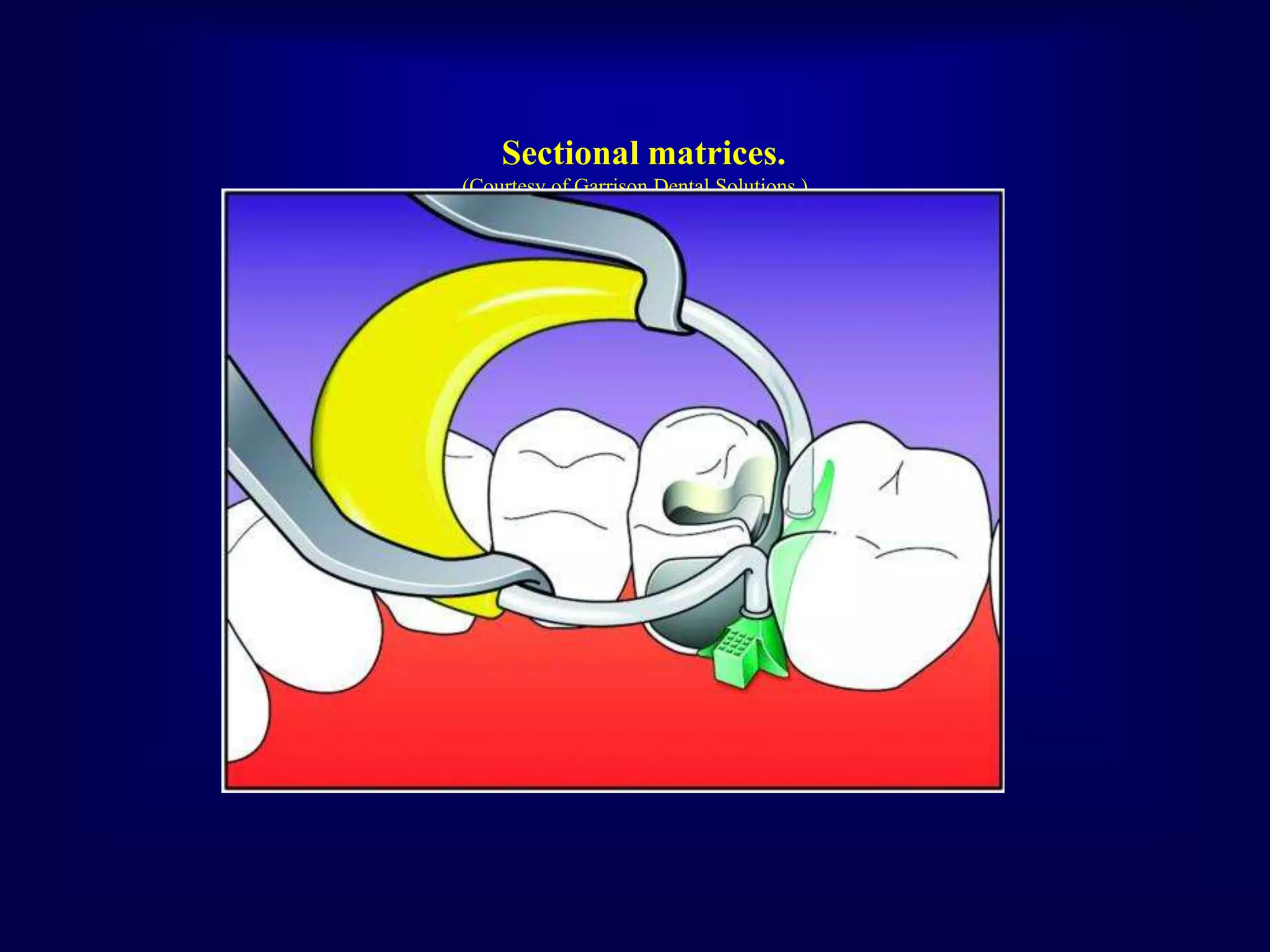 Matrices in-pediatric-restorative-dentistry | PPTX