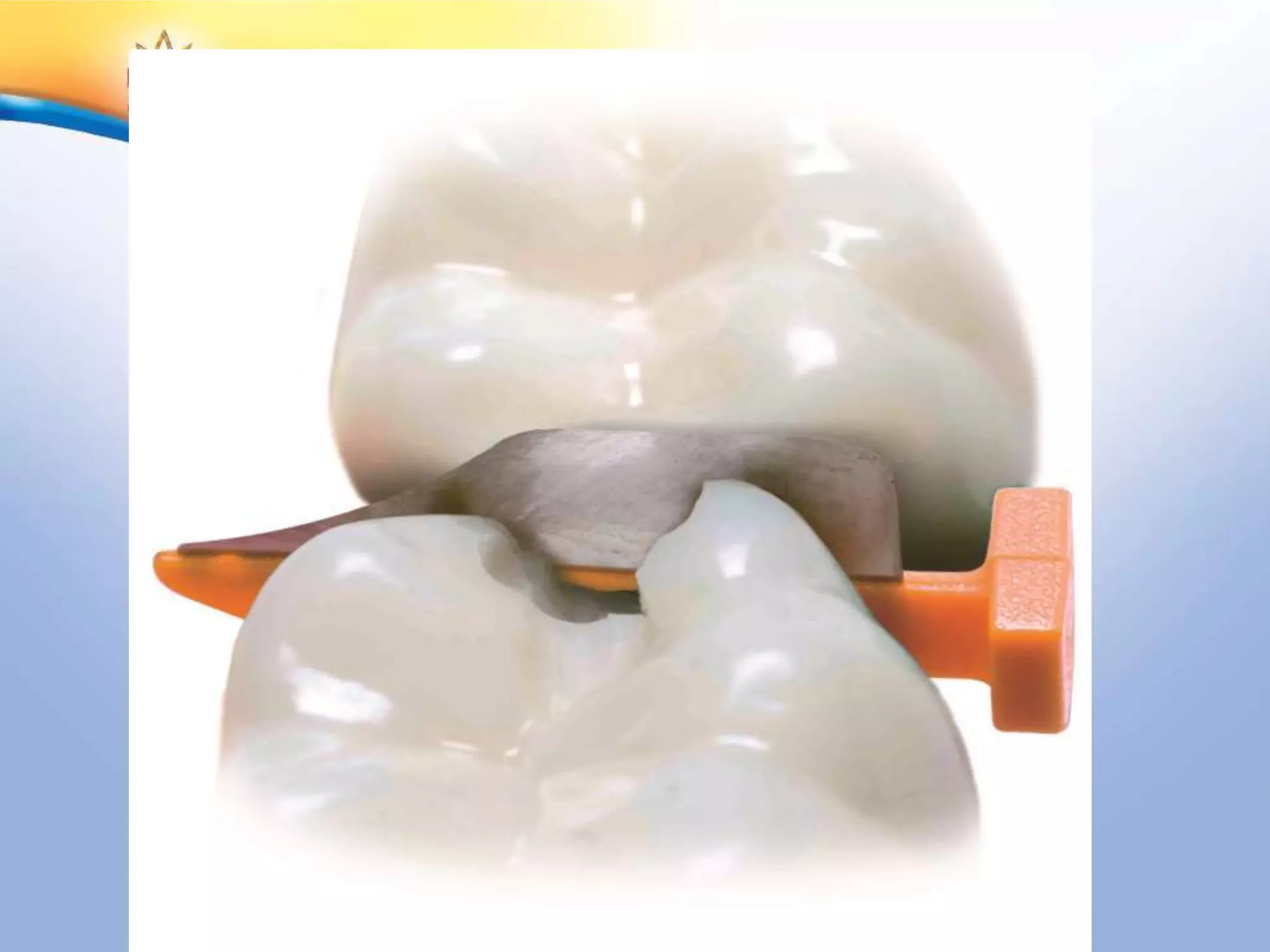 Matrices in-pediatric-restorative-dentistry | PPTX