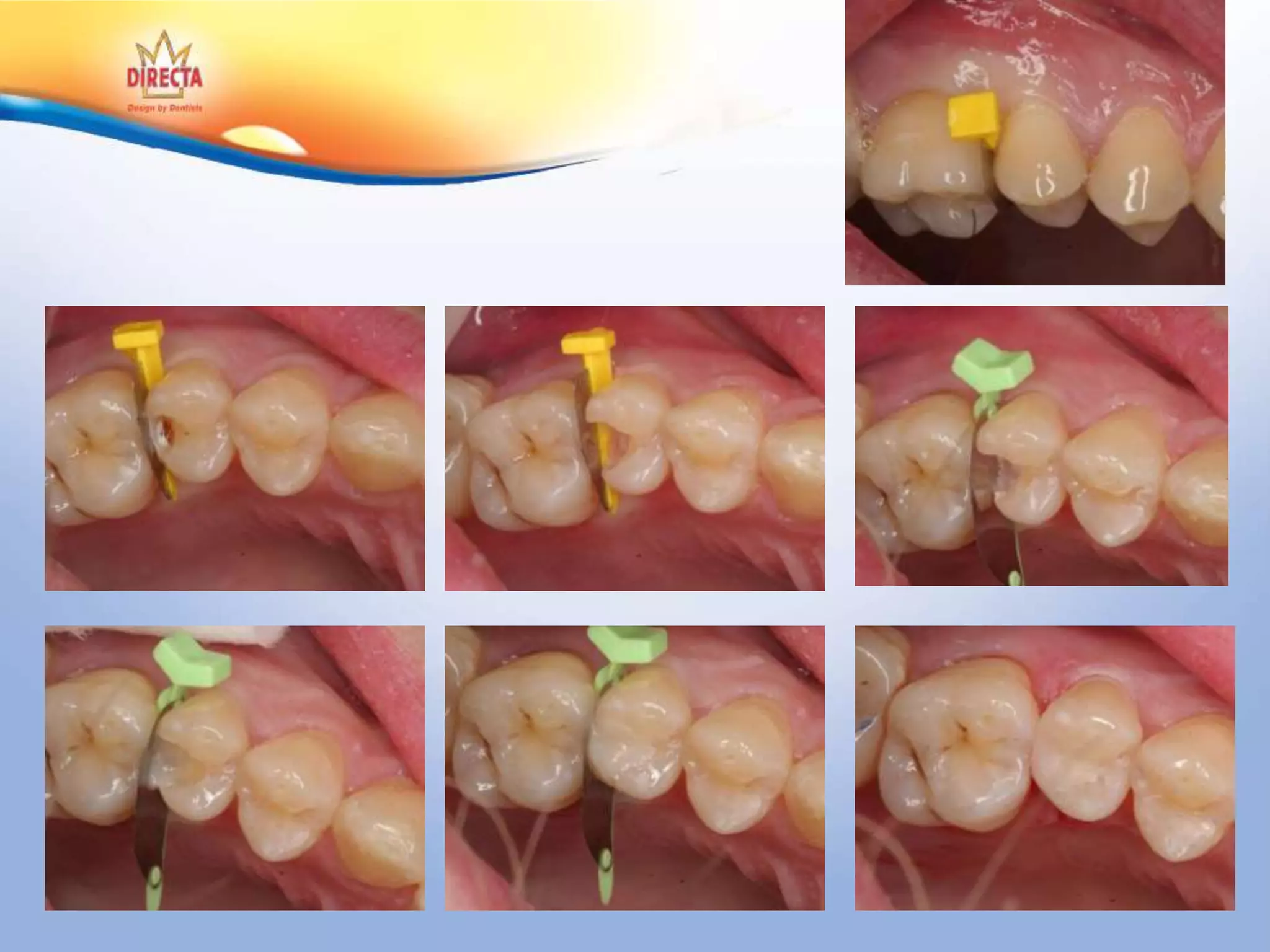 Matrices in-pediatric-restorative-dentistry | PPTX