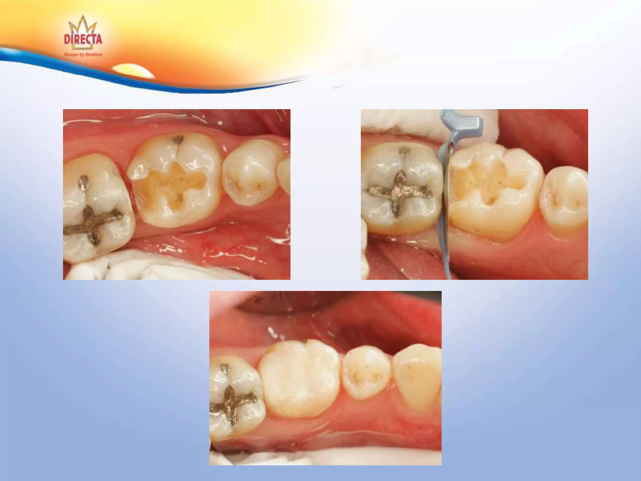 Matrices in-pediatric-restorative-dentistry | PPTX