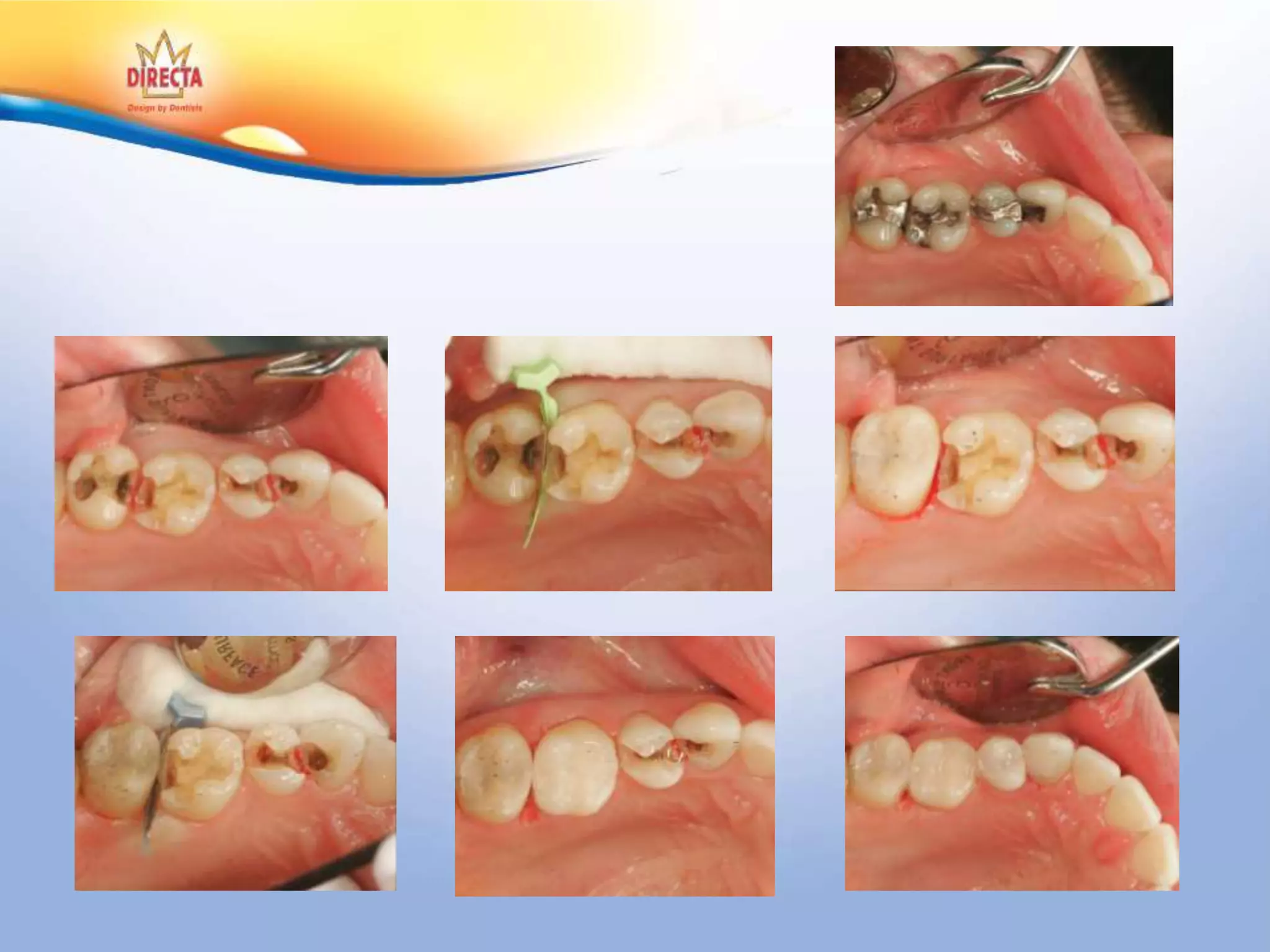 Matrices in-pediatric-restorative-dentistry | PPTX