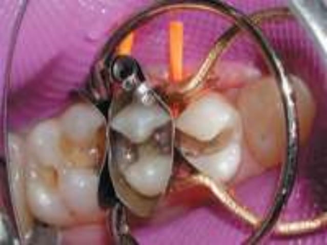 Matrices in-pediatric-restorative-dentistry | PPTX | Dental Health ...