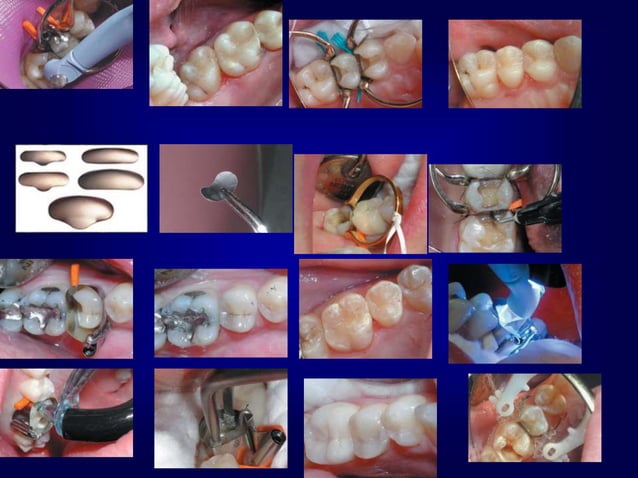 Matrices in-pediatric-restorative-dentistry | PPTX | Dental Health ...