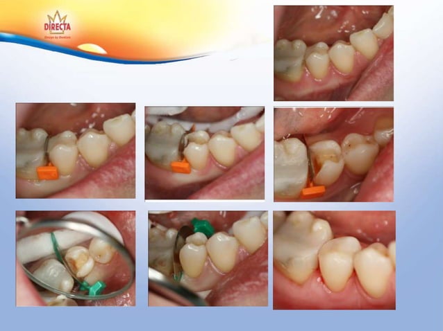 Matrices in-pediatric-restorative-dentistry | PPTX | Dental Health ...