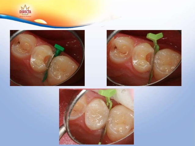 Matrices in-pediatric-restorative-dentistry | PPTX | Dental Health ...