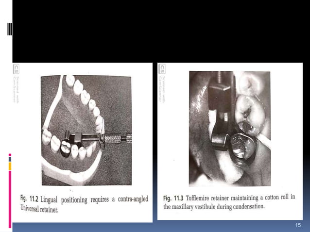 Matrices, retainers, wedges and separators | PPT | Dental Health ...