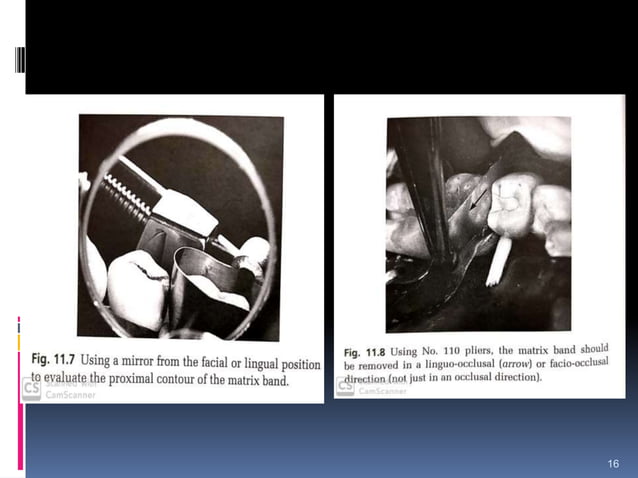 Matrices, retainers, wedges and separators | PPT | Dental Health ...