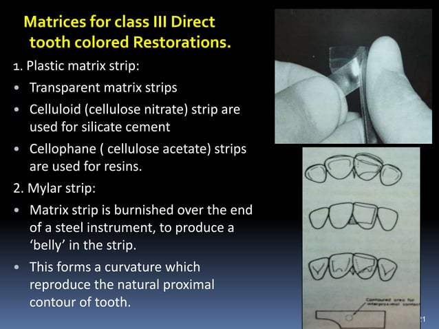 Matrices, retainers, wedges and separators | PPT | Dental Health ...