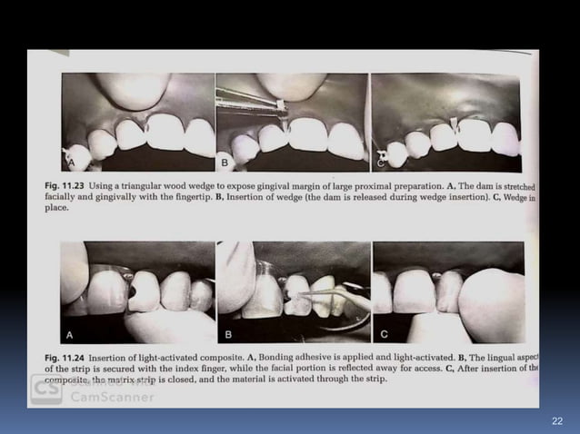 Matrices, retainers, wedges and separators | PPT | Dental Health ...