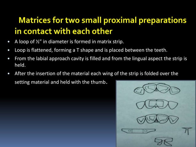 Matrices, retainers, wedges and separators | PPT | Dental Health ...