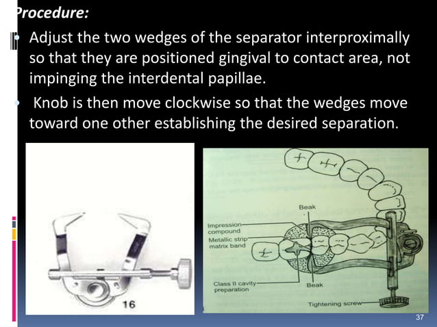 Matrices, retainers, wedges and separators | PPT | Dental Health ...