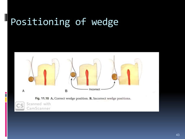 Matrices, retainers, wedges and separators | PPT | Dental Health ...