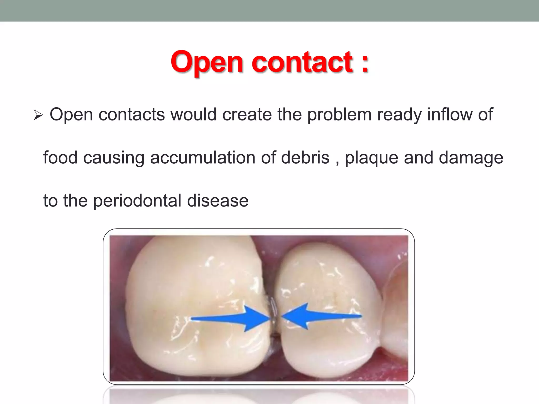 Matricing and tooth separation | PPTX