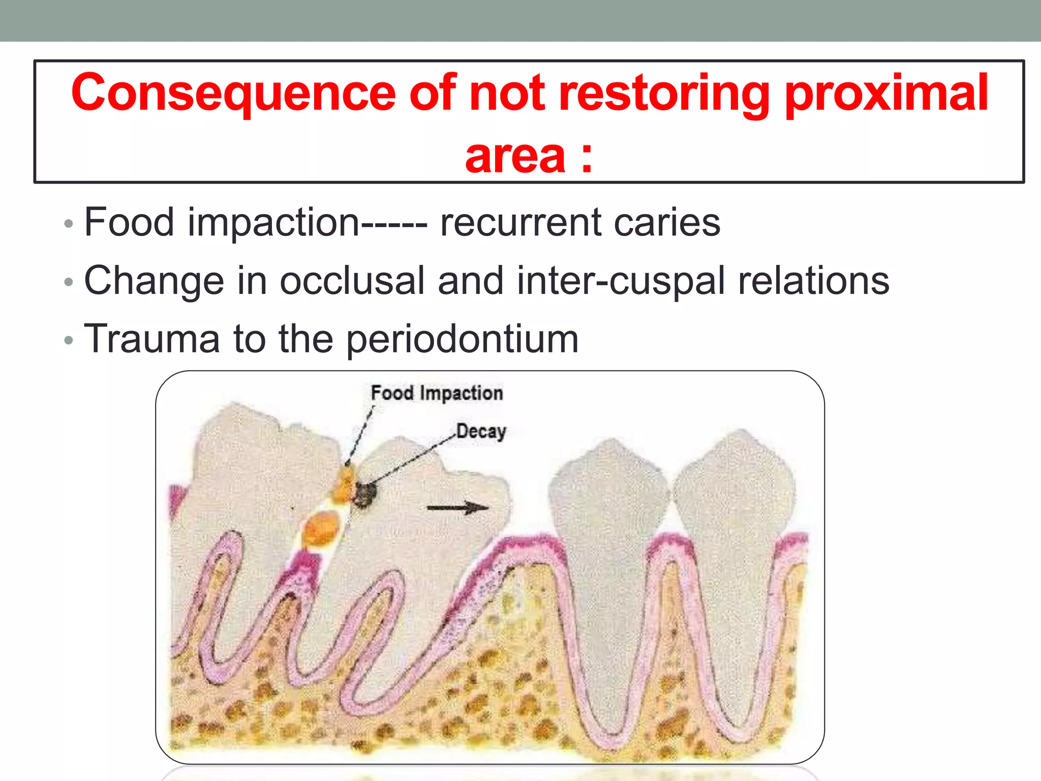 Matricing and tooth separation | PPTX