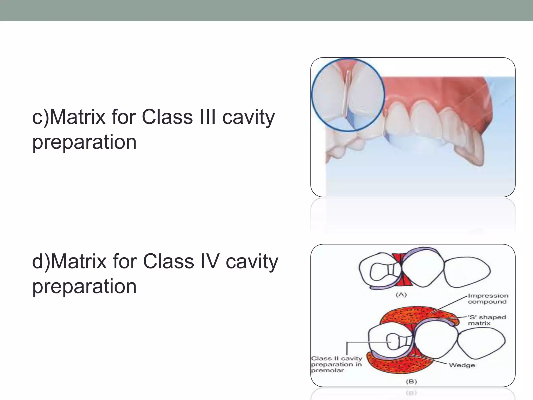 Matricing and tooth separation | PPTX