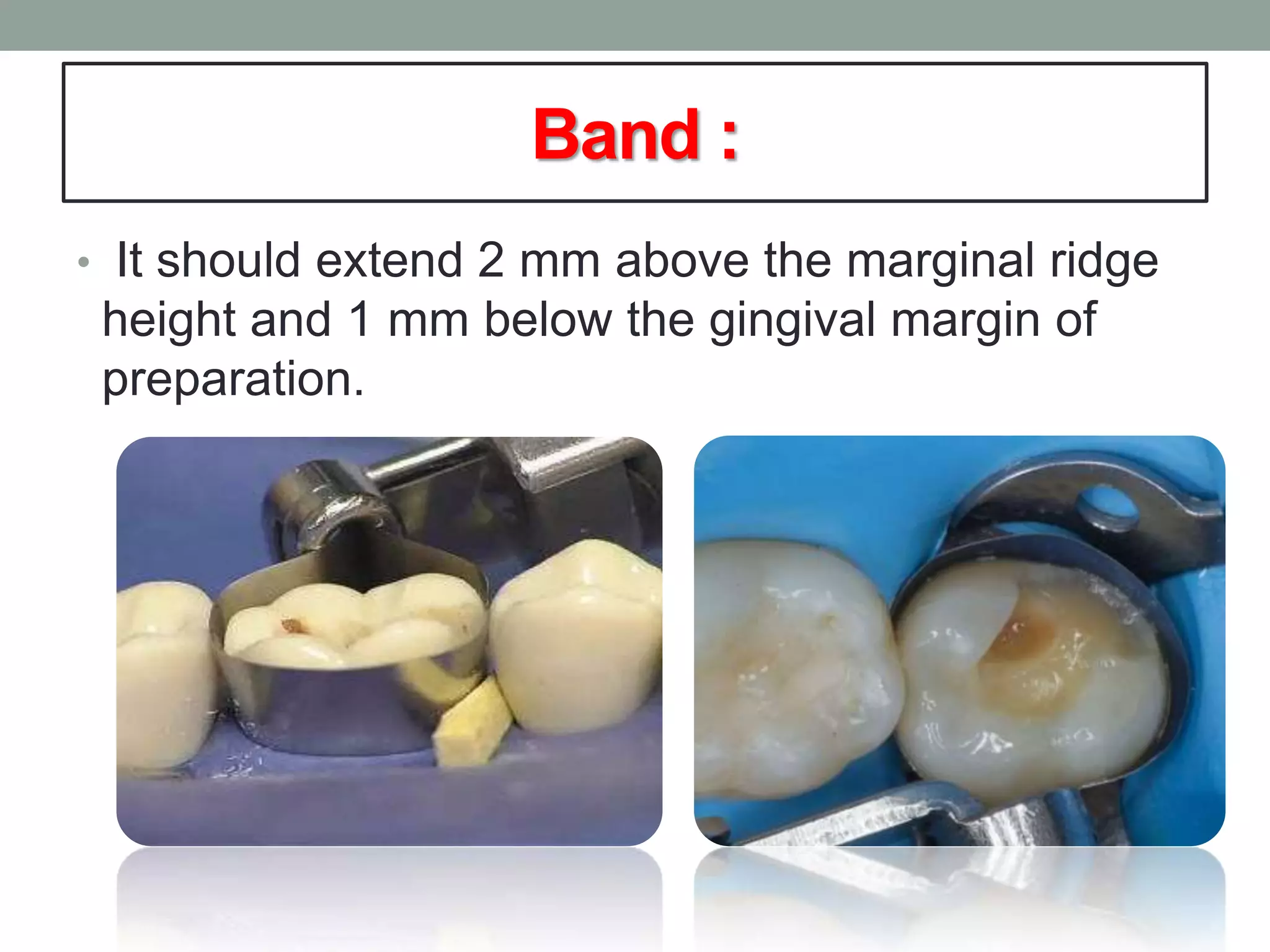 Matricing and tooth separation | PPTX