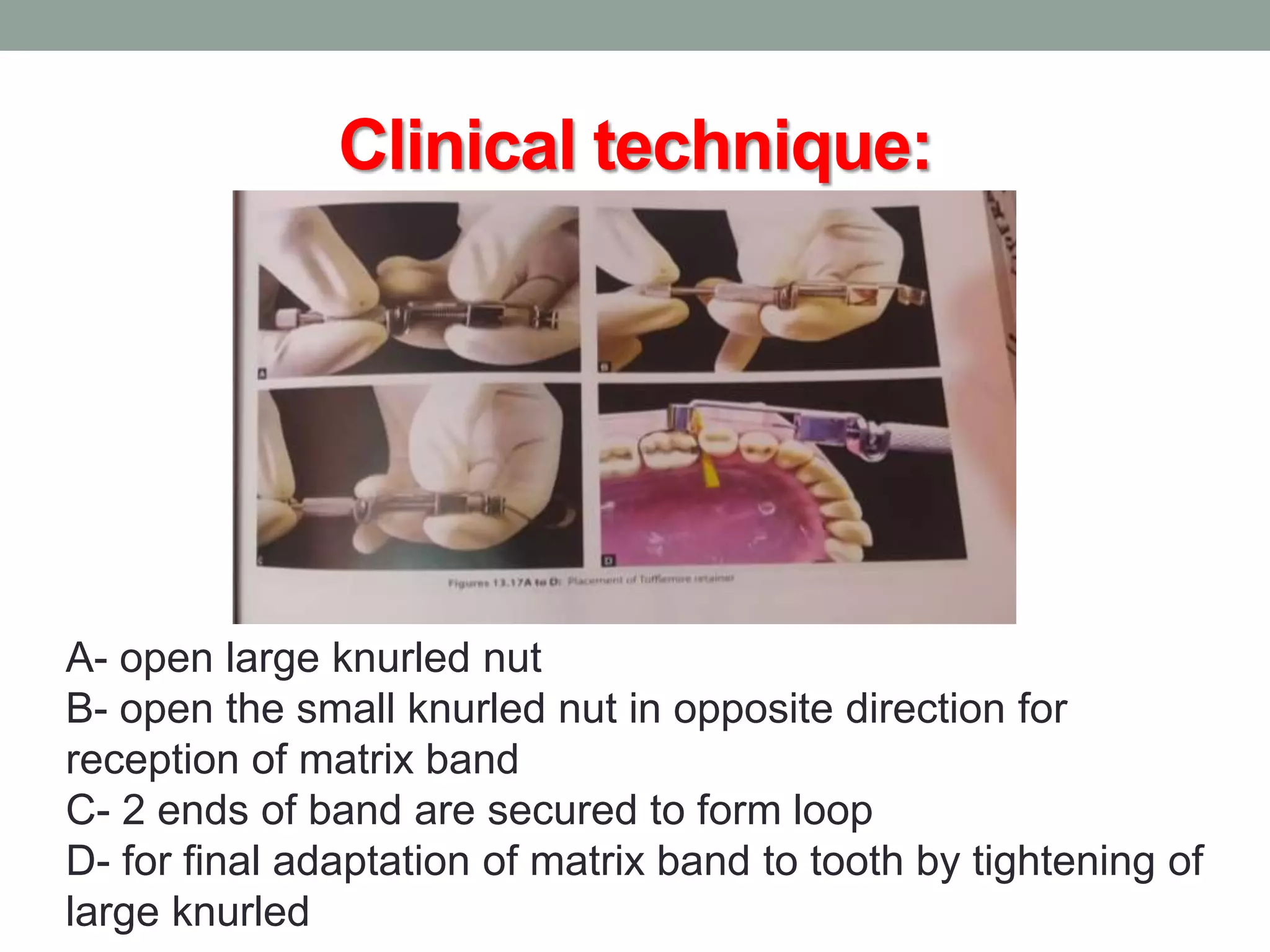 Matricing and tooth separation | PPTX