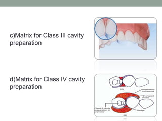 Matricing and tooth separation | PPT