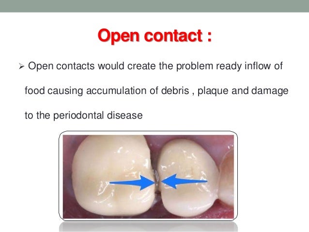 Matricing and tooth separation