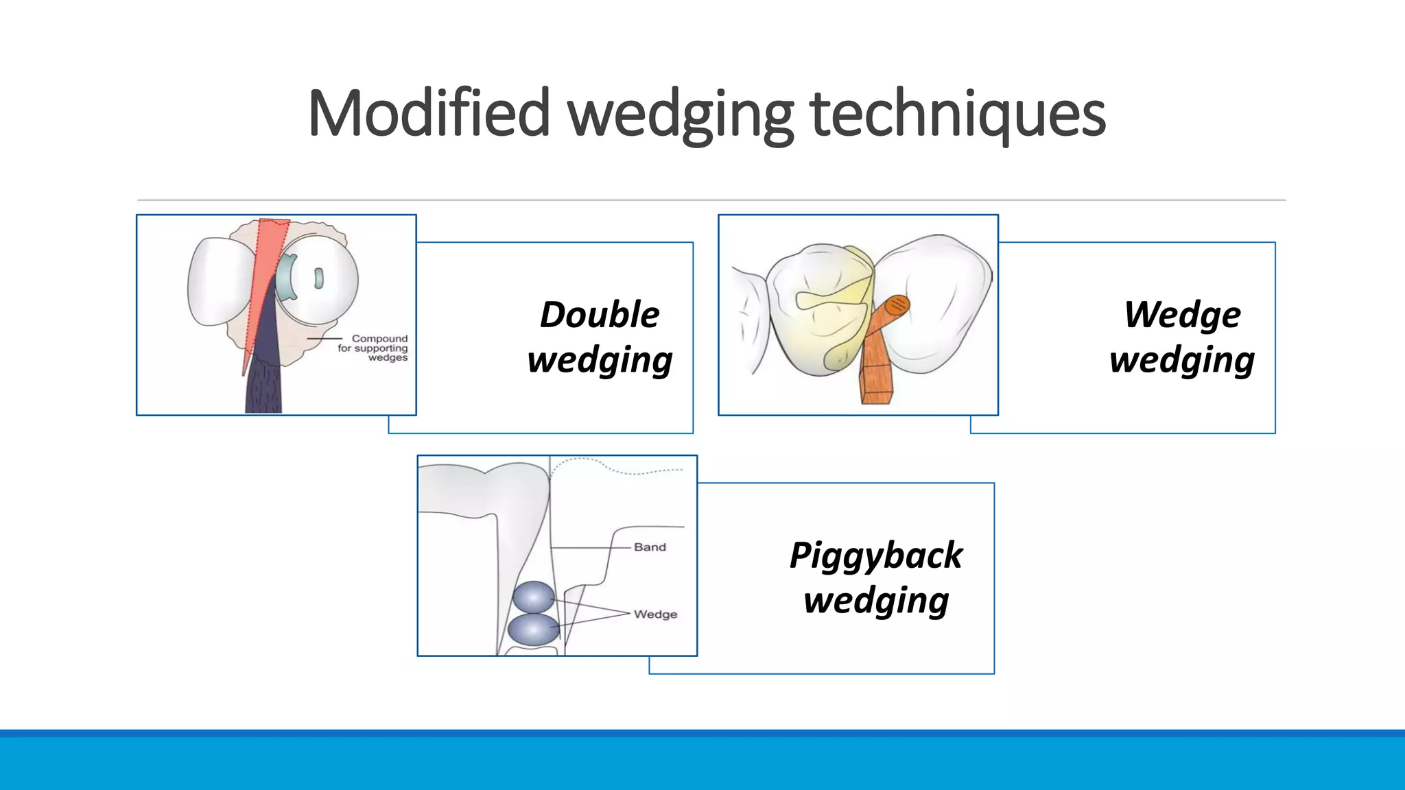 Matricing & Tooth Separation | PDF