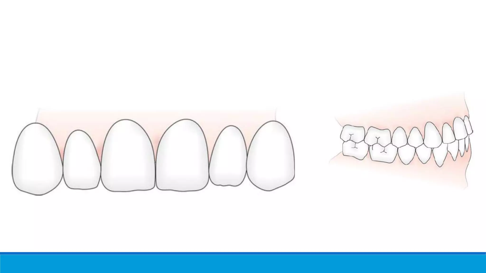 Matricing & Tooth Separation | PDF