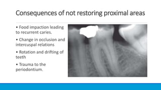 Matricing & Tooth Separation | PDF