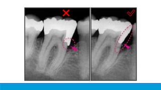 Matricing & Tooth Separation | PDF