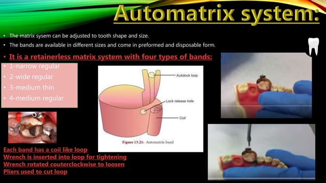 Matrix band system by Dr.Aisha Jamil | PPTX | Dental Health | Diseases ...