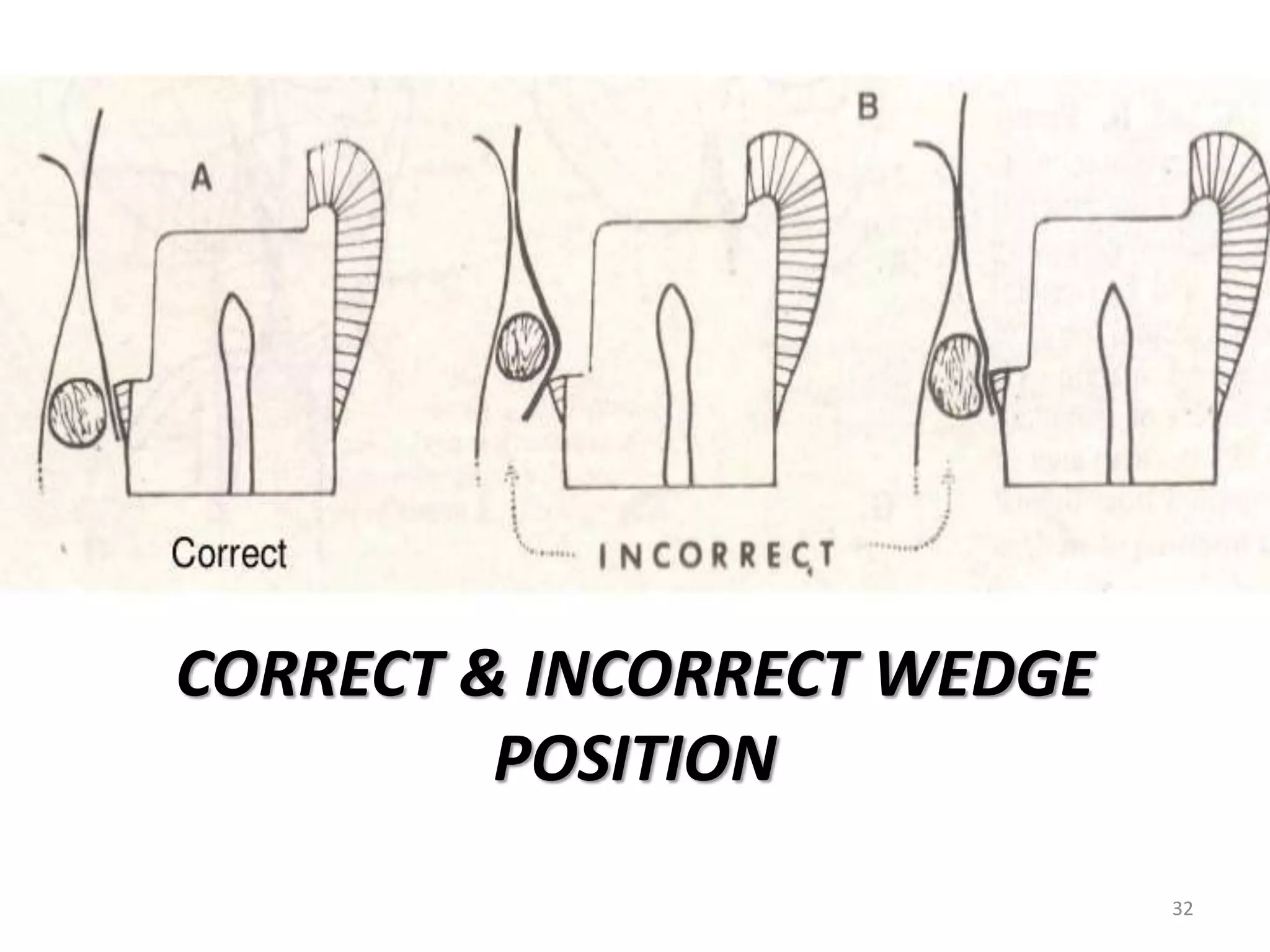 Matrixing and wedges | PPTX