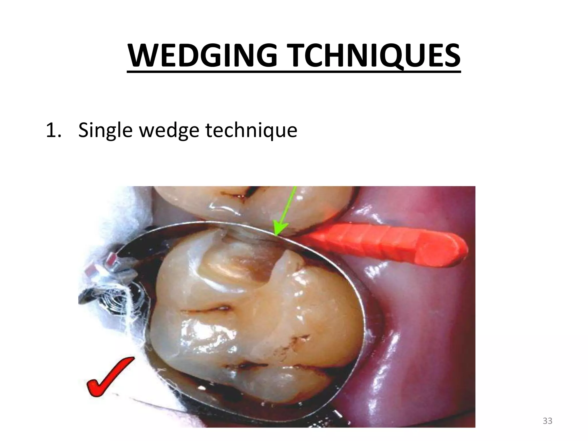 Matrixing and wedges | PPTX