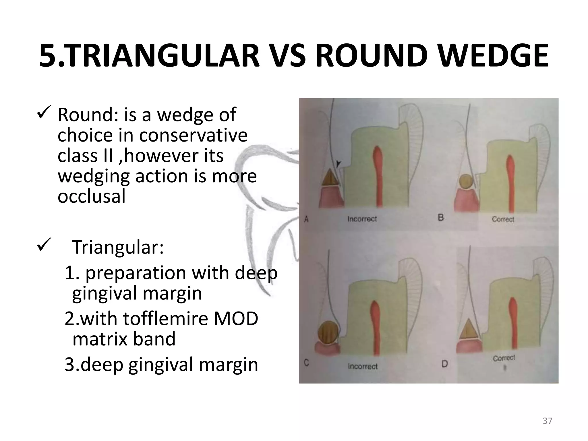 Matrixing and wedges | PPTX