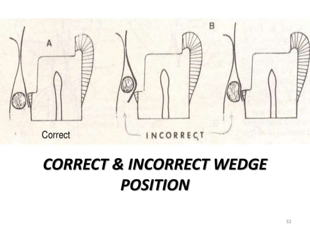 Matrixing and wedges | PPTX | Oral care | Personal Care