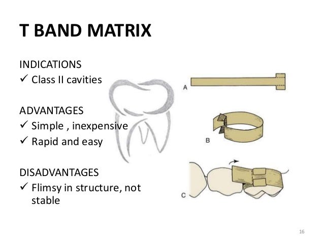 Matrixing and wedges